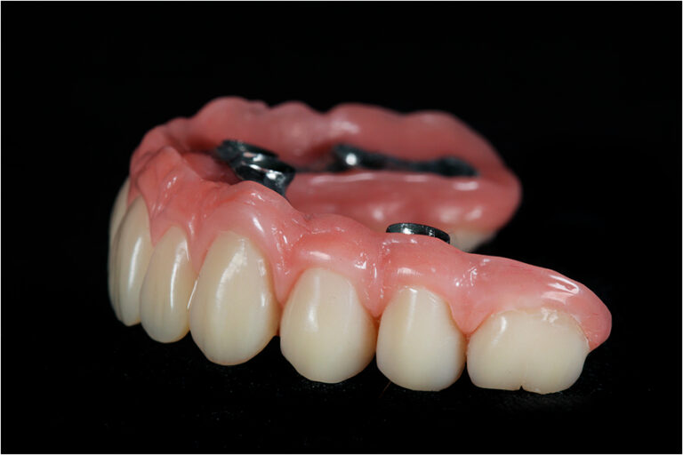 Prótese Fixa: Qual a diferença entre os outros tipos de próteses?